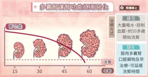 多囊腎不治療 10年就洗腎？ 治療、照護關鍵醫師圖文解說 照護線上