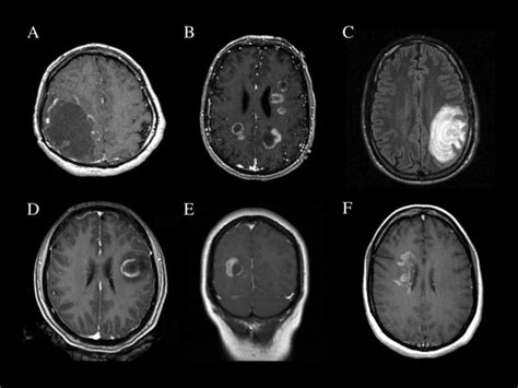 Clinical And Imaging Correlation In Patients With Pathologically Confirmed Tumefactive