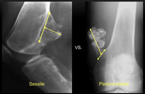 E2 Osteochondroma Flashcards Quizlet