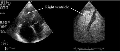 Endocardial Border Detection Of Right Ventricle Without Left And With Download Scientific