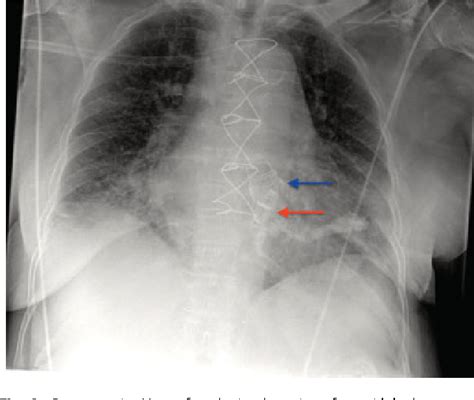 Mitral Valve X Ray At Patricia Buskirk Blog