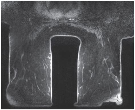 Breast Magnetic Resonance Imaging Radiology Key