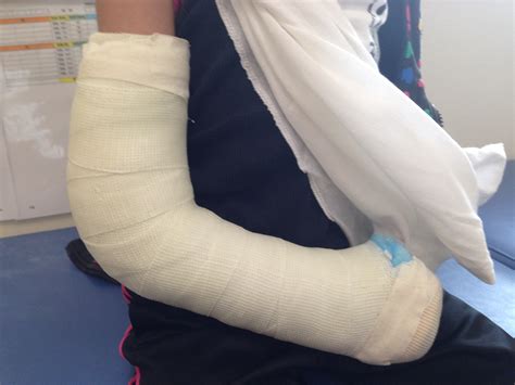 症例集：右上腕骨 顆上骨折（ヒビ） 急患できた太田市の患者さん ｜かわうちはり灸整骨院｜太田市・足利市