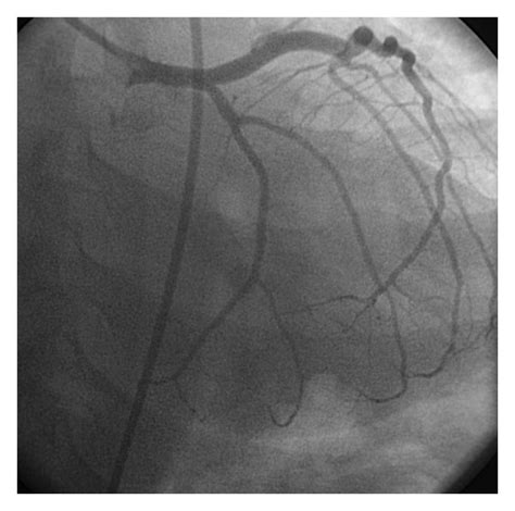 A Normal Rca Is Observed B Normal Lad And Left Circumflex Arteries