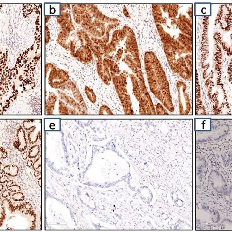 Tissue Microarray Analysis Of Tp53 Ihc Staining Staining Is Scored As Download Scientific