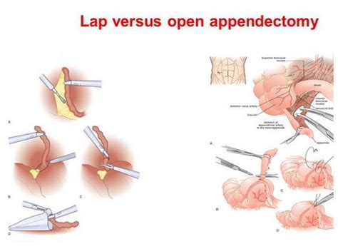Open Appendectomy