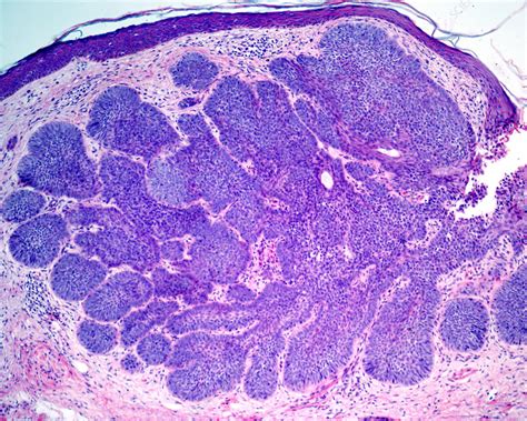 Basal Cell Carcinoma Light Micrograph Stock Image C0589963