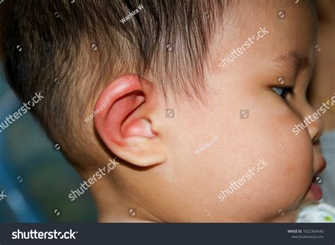 Ear Swelling Images Stock Photos Vectors Shutterstock
