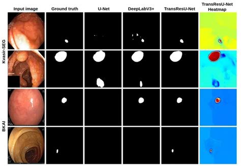 Transresu Net Transformer Based Resu Net For Real Time Colonoscopy Polyp Segmentation Bagci Lab