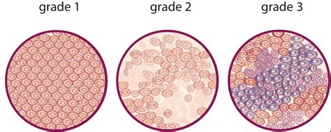 Cancer Staging And Grading Chart