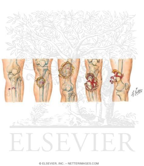 Gustilo And Anderson Classification Of Open Fractures