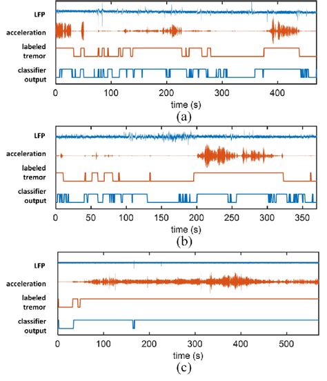 Examples Of Tremor Detection On Three Sample Lfp Recordings The Download Scientific Diagram