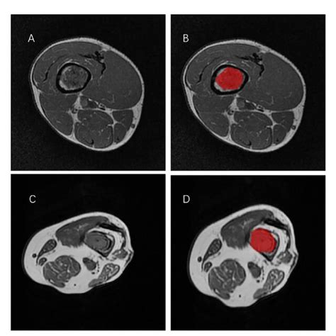 Two Representative T1wi Mri Segmentation On Itk Snap A B A Patient Download Scientific