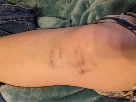 Numb Patch On Bruise Rmedicaladvice