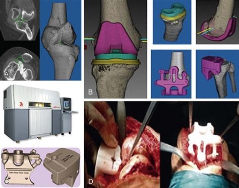 Custom Made Cutting Guides For Total Knee Arthroplasty