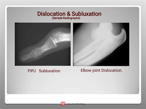 Definition Of Fracture Its Types Symptoms And Treatment Ppt