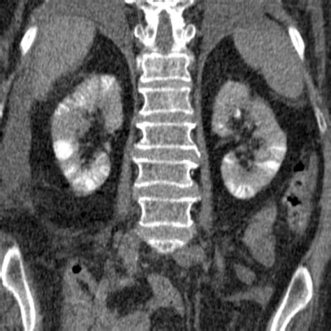 Acute Tubular Necrosis Image