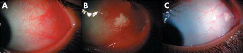 Active Diffuse Anterior Scleritis In The Temporal Quadrant Of The Left