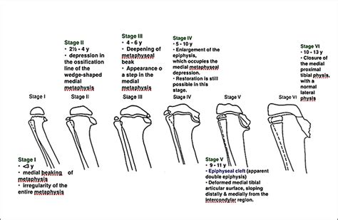 Blounts Disease Singapore Diagnosis And Treatment