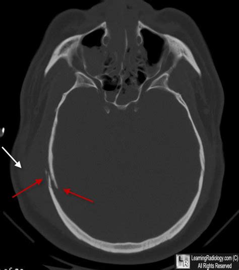 Basal Skull Fracture Ct Scan At Alexander Feakes Blog