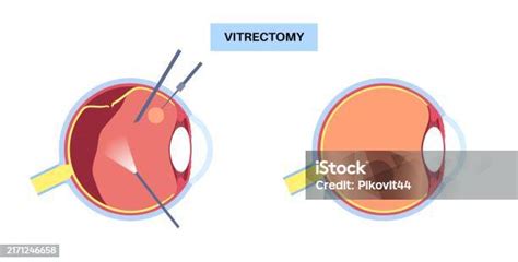 Vitrectomy Surgical Poster Stock Illustration Download Image Now