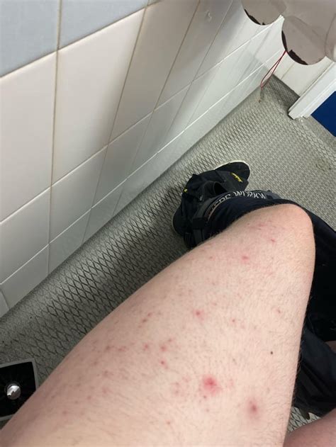 Other Women With Chronic Folliculitis On Back Of Thighs R Folliculitis