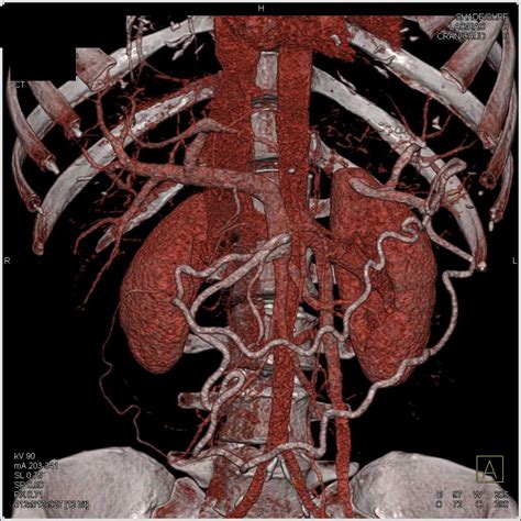 Adenocarcinoma Pancreas Pancreas Radiology Case Studies Ctisus Ct