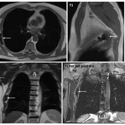 Mri Scan For Chest Medifyhome