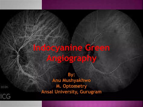 Indocyanine Green Angiography Icg Pptx