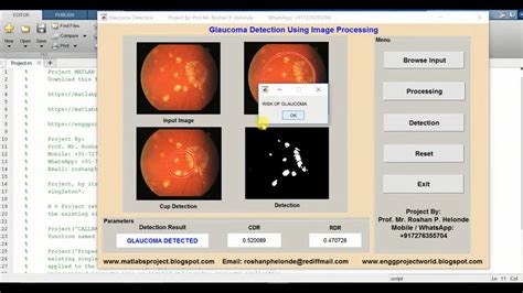 Glaucoma Detection Using Image Processing Glaucoma Detection Using