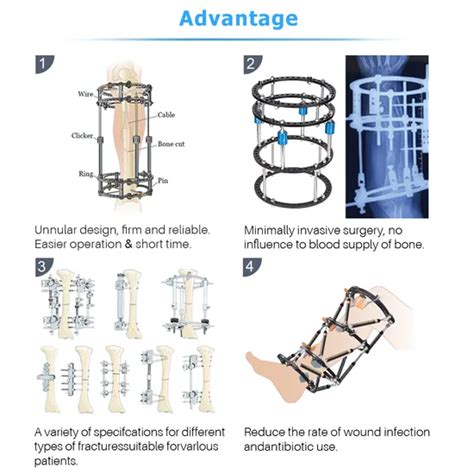 External Fixator Stainless Steel Bar Pelvic Ulna Radius Wrist Joint Bone External Fixation