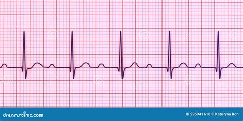 An Ecg Displaying 1st Degree Av Block 3d Illustration Stock