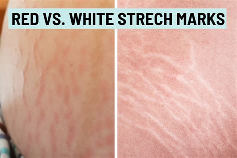 Red Stretch Marks Striae Rubra Causes How To Treat Them