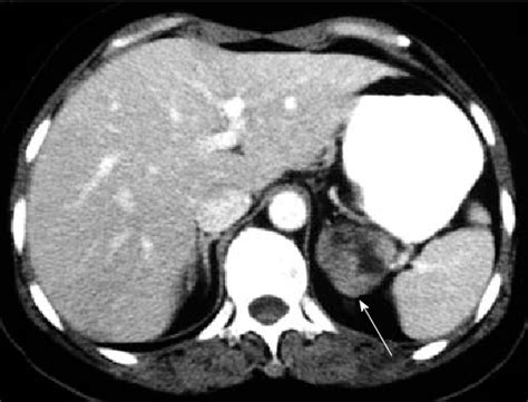 Figure 1 From Laparoscopic Resection Of Gastric Gastrointestinal Stromal Tumors Presenting As