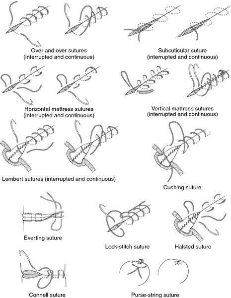 Inverting Suture 3 Definition Of Inverting Suture 3 By Medical Dictionary