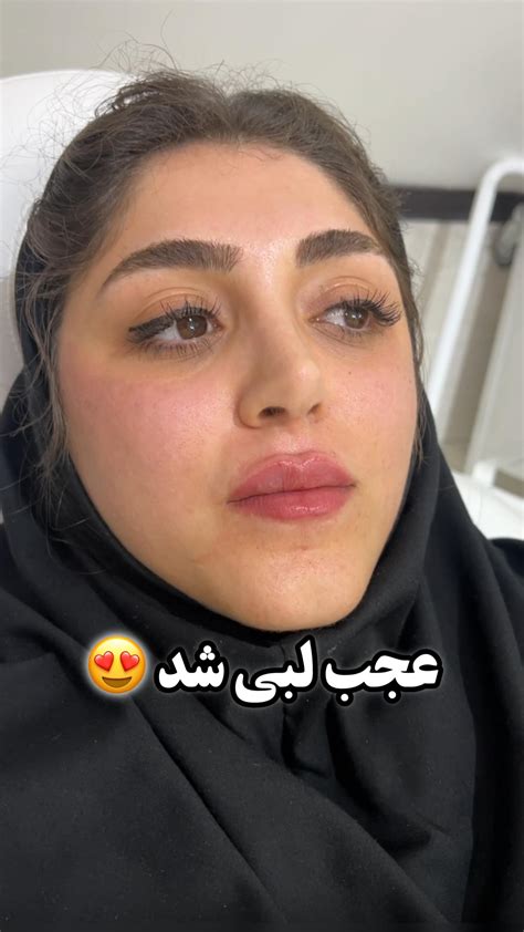 ‎دکتر فاطمه کرد لب روسی بوتاکسکانتورینگ صورت‎ Drfatemehkord