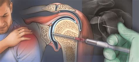 Arthrogram — The Interventional Initiative