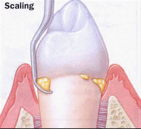 Indications And Rationale For Scaling And Root Planing Flashcards Quizlet