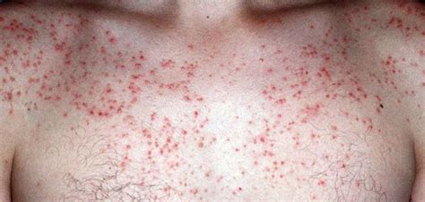 Pathogens 10 Common Pathogens