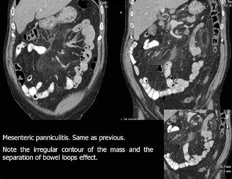 Root Of Mesentery Anatomic And Pathologic Review Semantic Scholar