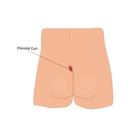 Pilonidal Cyst A Complete Overview Proctology