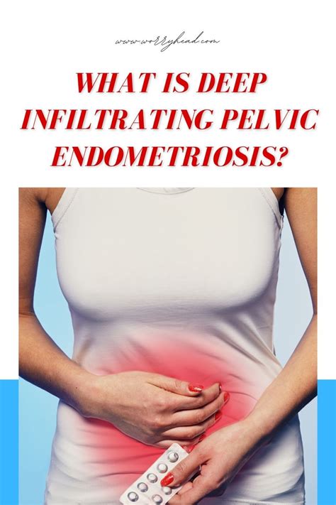 What Is Deep Infiltrating Pelvic Endometriosis Endometriosis Artofit