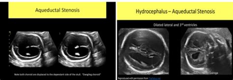 Fetal Brain Abnormalities Flashcards Quizlet