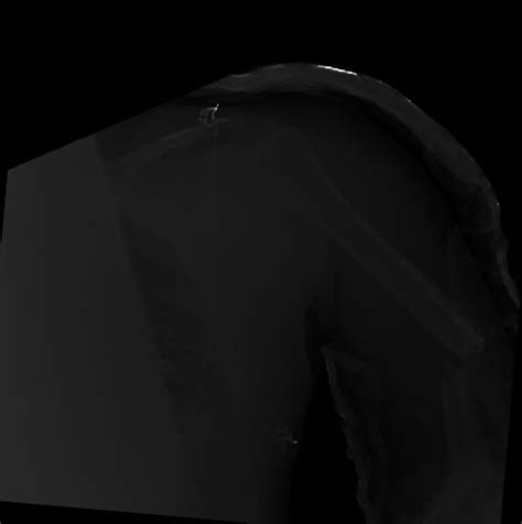 X Ray Fracture Bbox Object Detection Dataset By Abdullah Work Space