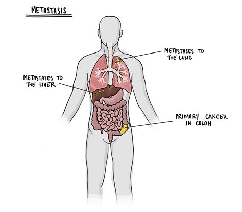 Metastase Mypathologyreport
