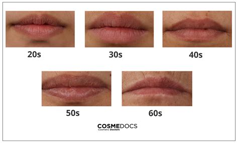 Upper Lip Wrinkle Removal Store