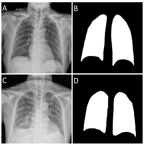 Sensors Free Full Text Machine Learning Model Based On Radiomic Features For Differentiation