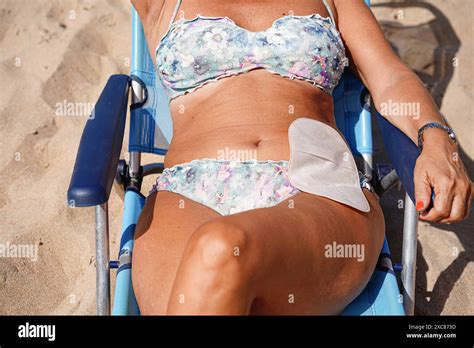 Unrecognizable Woman With An Ostomy Bag Sitting In The Beach Health