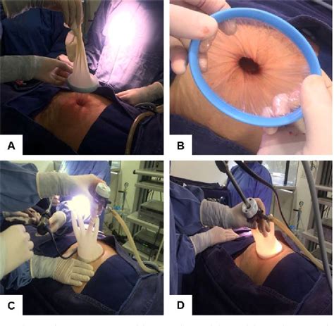 Single Incision Laparoscopic Appendectomy With Surgical Glove Port Is Cost Effective And
