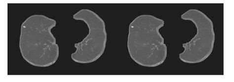 Github Yashika03lung Nodule Segmentation Using Squeeze And Excitation Dense Unet